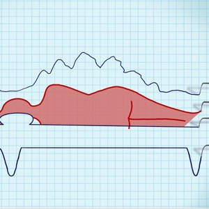 Sleep Disorders and Mental Health